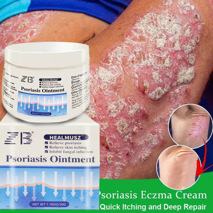 ZB 50g Psoriasis Ointment for Inhibit fungal Infection,Relieve ...