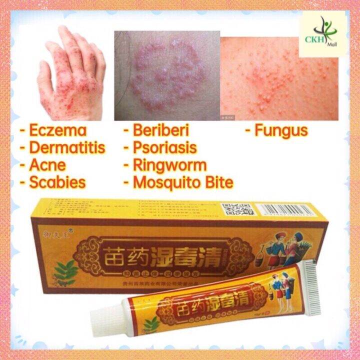 Eczema Psoriasis Beriberi Fungus 100% Chinese Herbal Cream Ubat Gatal ...