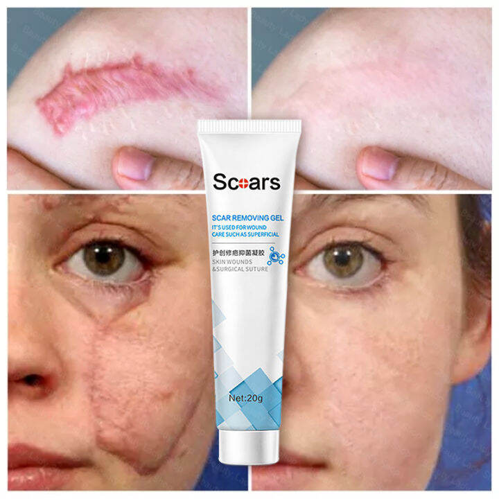Scar gel remover scar remover cream scar remover for old scar remover ...
