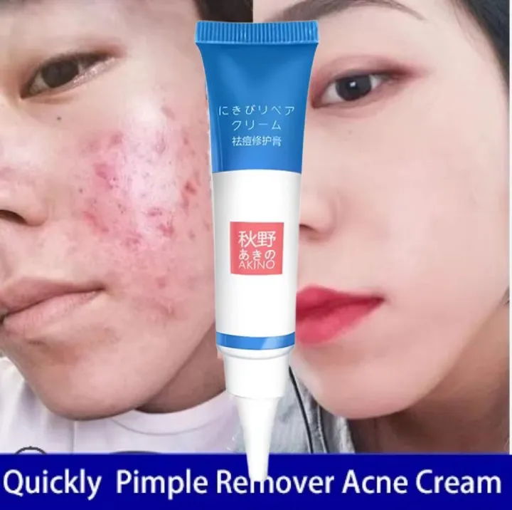 Remove Pimples Quickly Acne gel scar remover Pimple Remover Acne Cream Fades Acne Marks Repairs ...