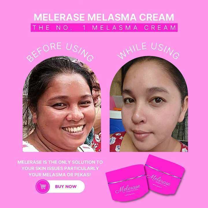 MELERASE MELASMA CREAM 12g BY BELLE GLOW | Lazada PH