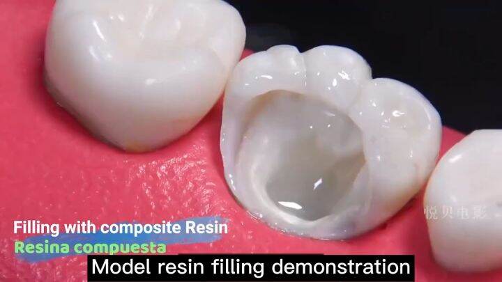 Dental Light Curing Composite Resin Universal Adhesive Bonding Filling ...