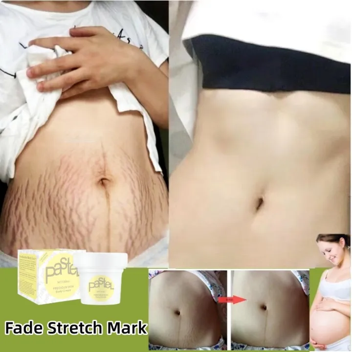 menghilangkan stretch mark krim perbaikan pasca persalinan 30g mengenccangkan memudarkan garis ...