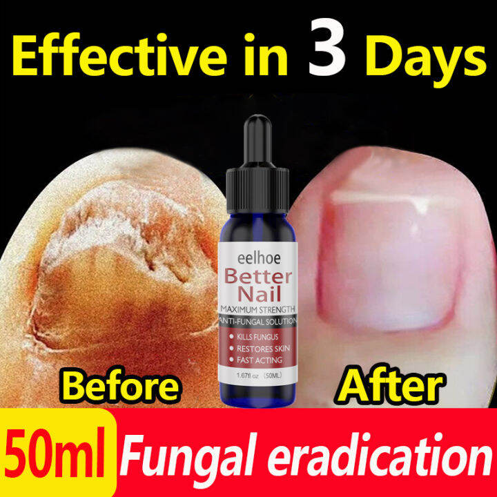 【Effective in 3 days】Nail fungus repair Nail repair liquid 50ml Quickly ...