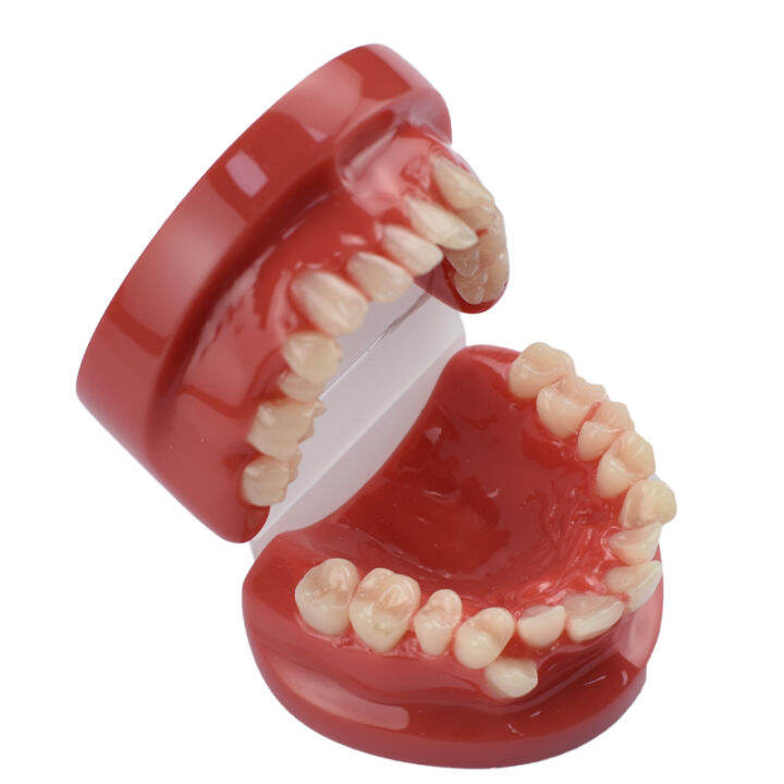 3D Resin Dental Model Teeth Malocclusion Model For Demostration ...