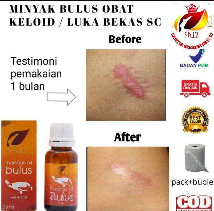OBAT KELOID MENONJOL TAHUNAN AMPUH OBAT KELOID PALING AMPUH OBAT KELOID ...
