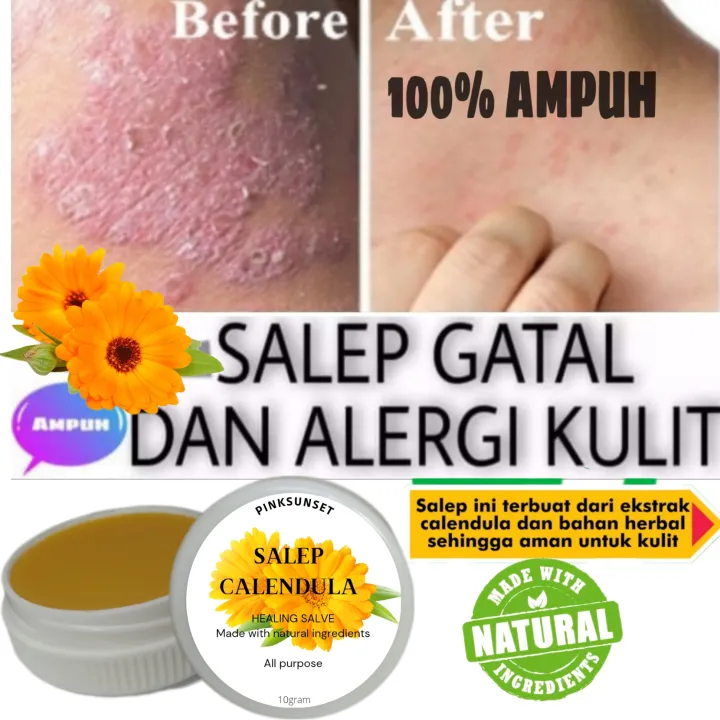 Salep Calendula Healing salve Salep Obat Gatal Eksim Kering Salep Gatal ...