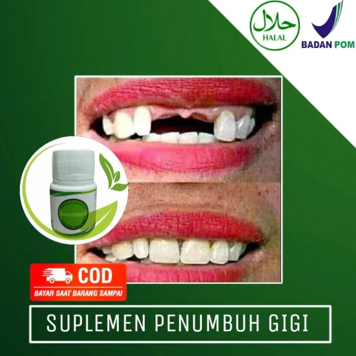 SUPLEMEN PENUMBUH GIGI ORIGINAL MENUMBUHKAN GIGI BERLUBANG, GIGI OMPONG ...