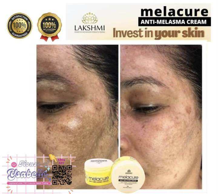Lakshmi Melacure Anti-Melasma Cream 30g - Pekas Remover, Luminous Skin & Youthful Charm | Lazada PH