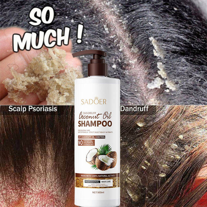 SADOER Coconut Oil Nourishing Anti Dandruff Shampoo Psoriasis Shampoo Itchy Scalp Oil Control ...