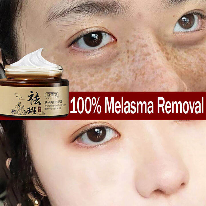 Effective Herbal freckle removal whitening cream melasma removal cream ...