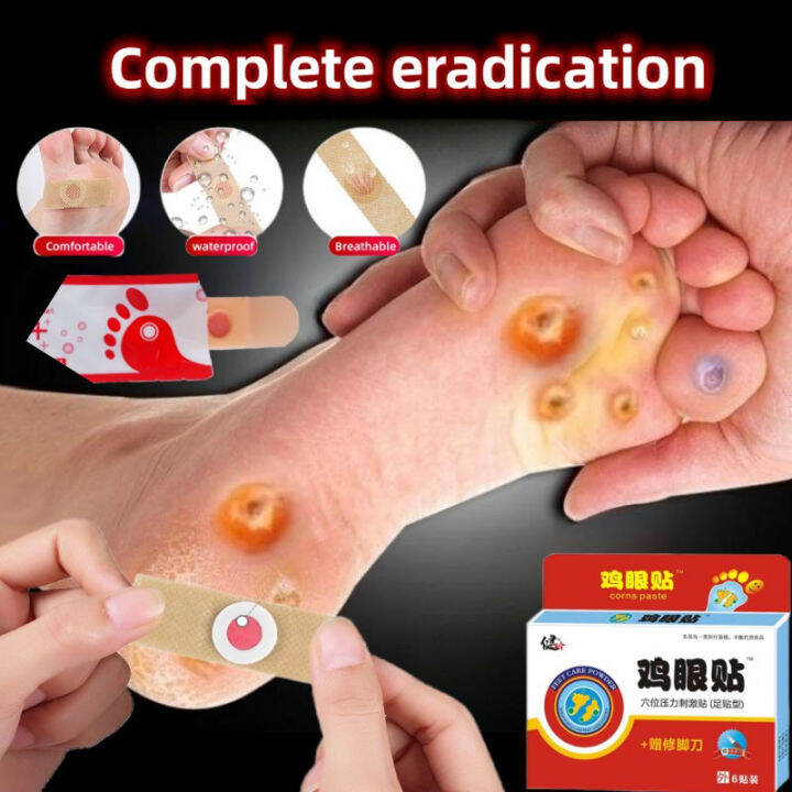 Foot Corn Removal Foot Patch Corn removal patches 6 patches/box Warts ...
