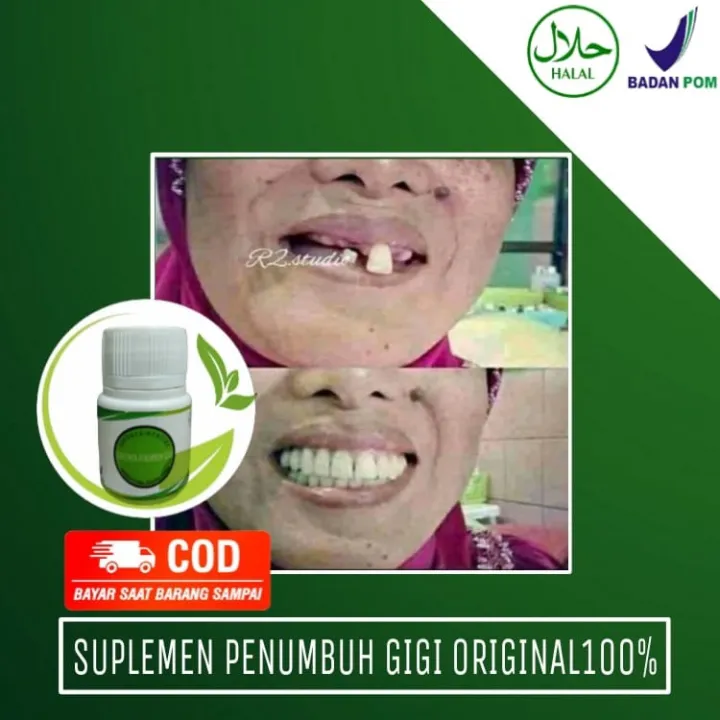 PENUMBUH GIGI DEWASA, GIGI KROPOS DAN BERLUBANG PALING AMPUH BISA COD ...