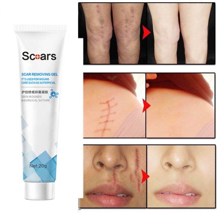 Scar remover for old scar on leg Effective Scar Repairing Gel light ...