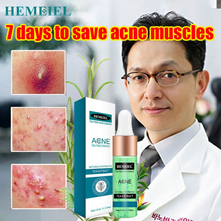 HEMEIEL Men Tea Tree Acne Remover/ Fast Acne Treatment Serum /Anti Acne ...