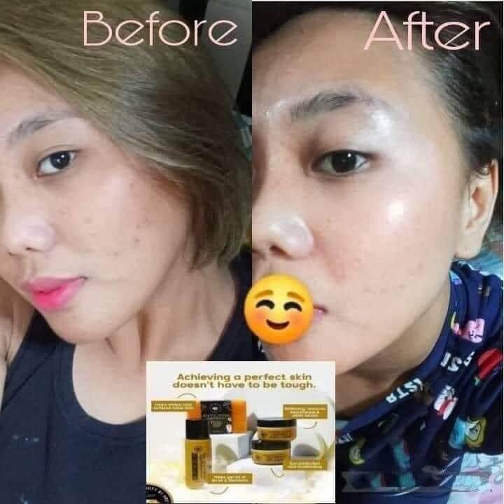 10X WHITENING REJUV PERFECT RADIANCE SET with Freebie na WALANG HAPDI ...