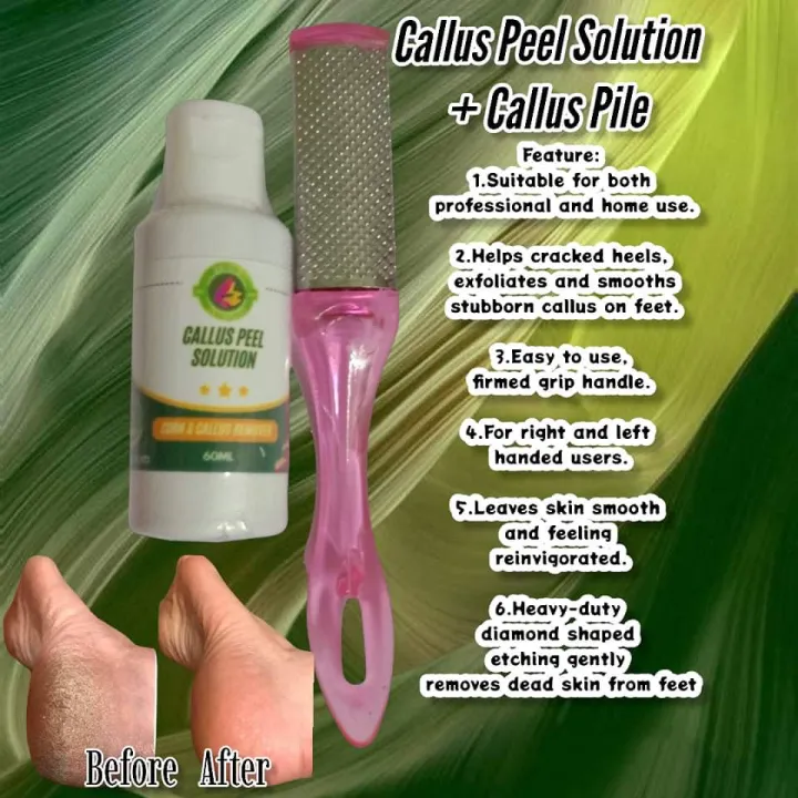 CALLUS REMOVER/PANGTANGGAL KALYO 60ML | Lazada PH