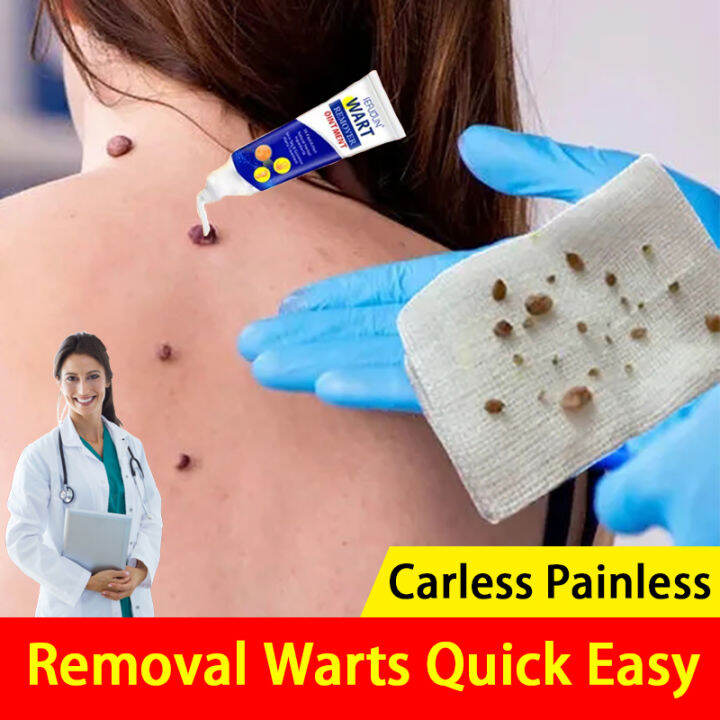 Easily and Quickly Warts Remover Original Cream Warts Magic 20g Remover ...