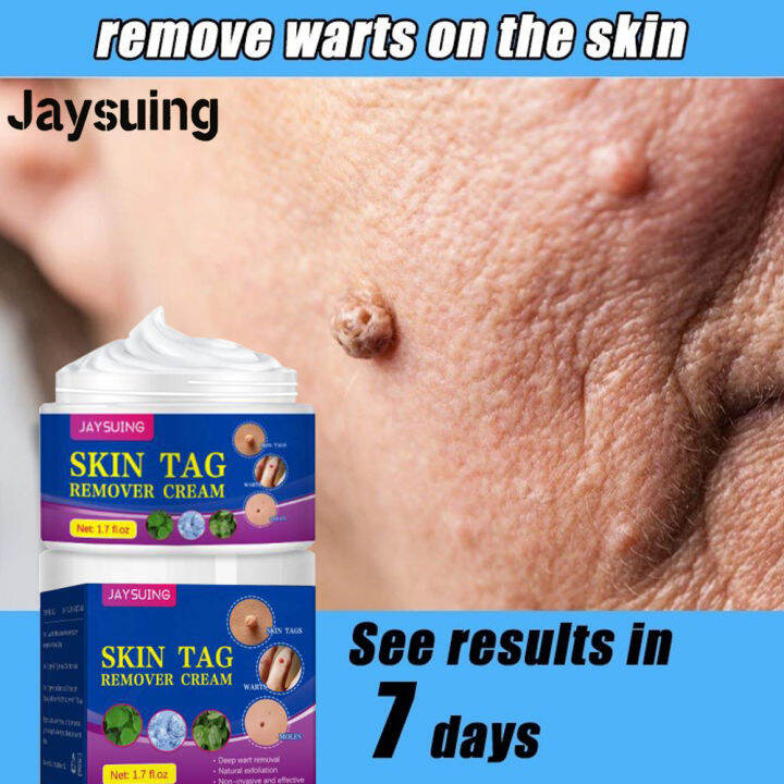 Jaysuing Skin Tag Remover Cream Painless Mole Skin Dark Spot Warts ...