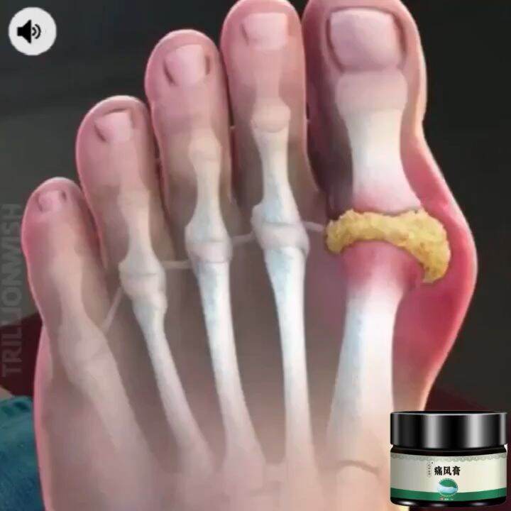 gout ointment ubat gout 35g Natural Chinese herbal medicine gout ...