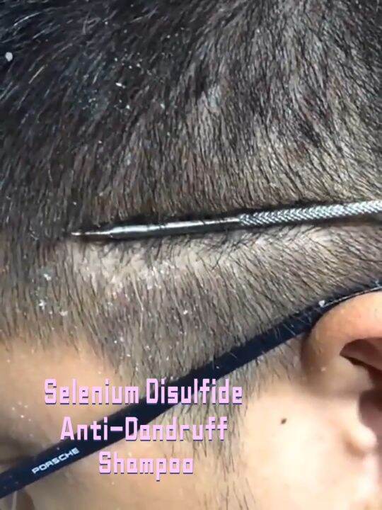 300ml Selenium Disulfide anti-dandruff and anti-itch Shampoo Refreshing ...