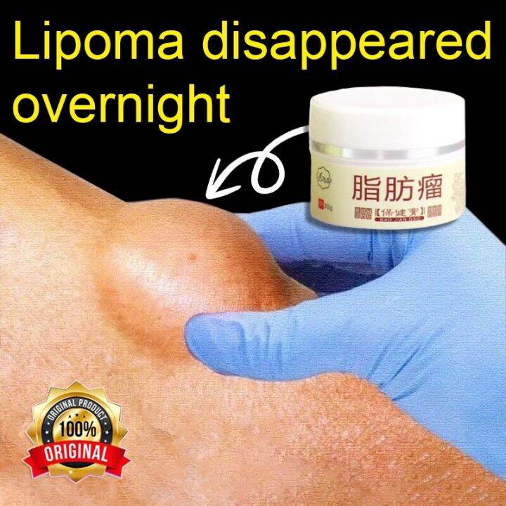 Lipoma removal Cream lipoma cream 脂肪瘤 30g Fat Granule Care Removing ...