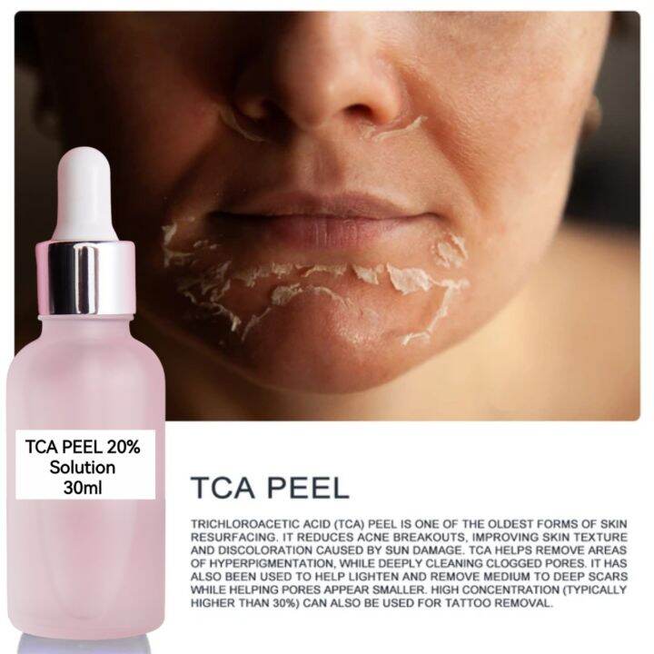 TCA PEELING SOLUTION 20% 30ML / Safe for Pregnant Breastfeeding ...
