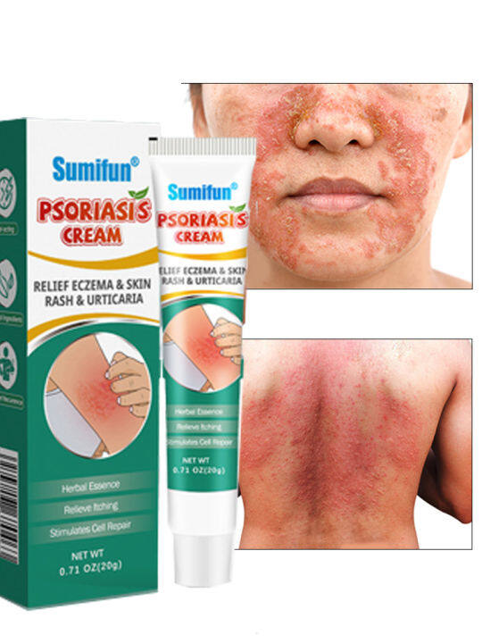 Psoriasis Eczema Cream Anti Itching Antibacterial Atoderma Ointment