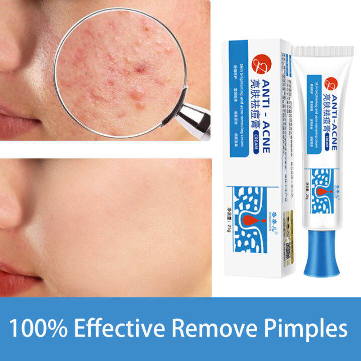 Acne Repair Cream Original 100% Effective Remove Pimples Quickly Pimple Remover Acne Cream Fades ...