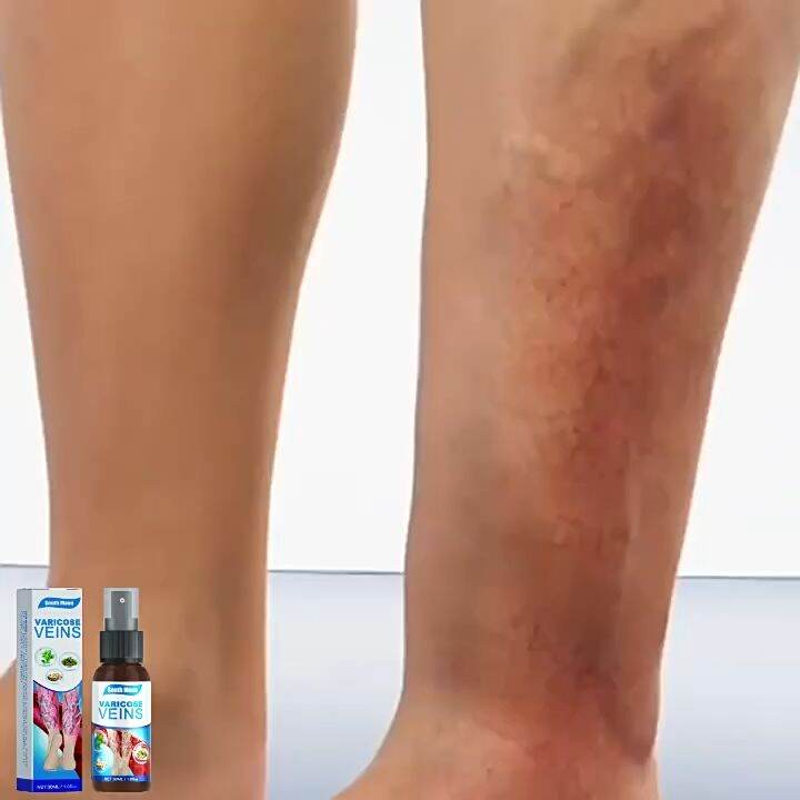 South Moon Varicose Veins Spray Intravenous Spray Relieve Smooth Blood ...