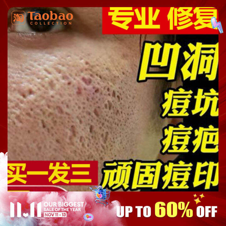 Anti-Acne Marks Pox Pits Acne Scars Concave Hole Repair Filling ...