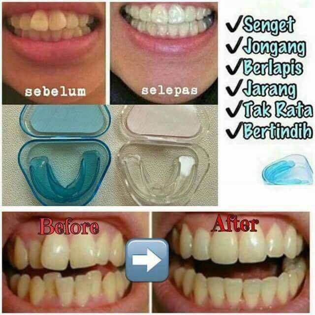TEETH TRAINER Cantikkan gigi jonggang berlapis bertindih tidak rata ...
