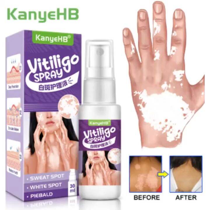 KanyeHB White Spot Spray Vitiligo Antibacterial Spot Removal Improves ...
