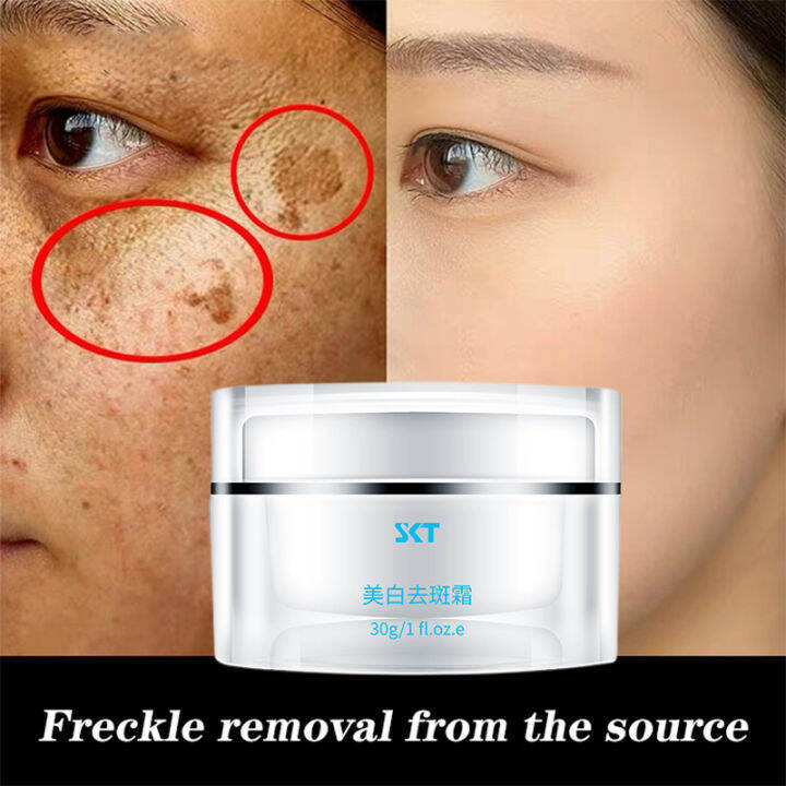 Krim jeragat melasma acne spot treatment freckle cream pigmentation ...