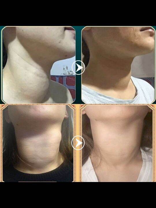 ubat Leher bengkak thyroid cream neck lump Herbal Hyperthyroidism ...