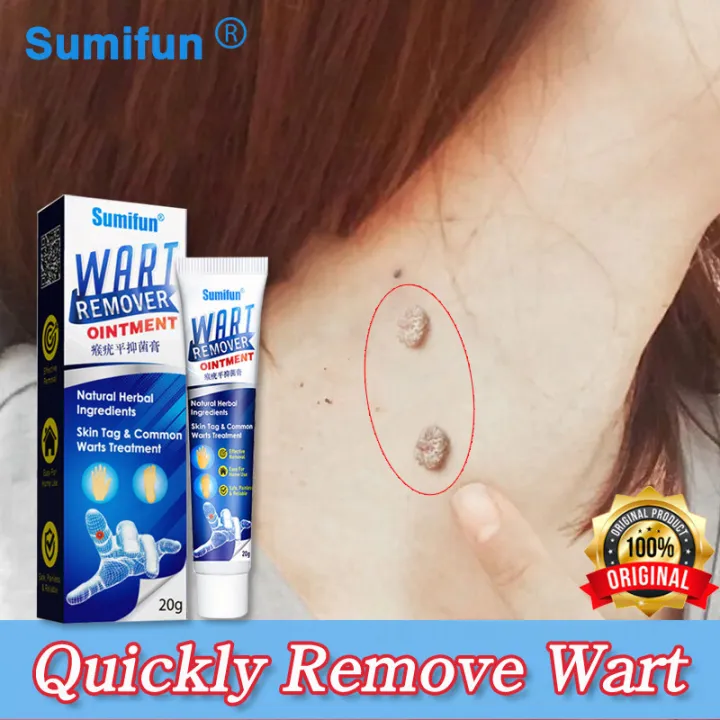 Warts Remover Original Cream Warts Magic Remover Wartz Removal Cream ...