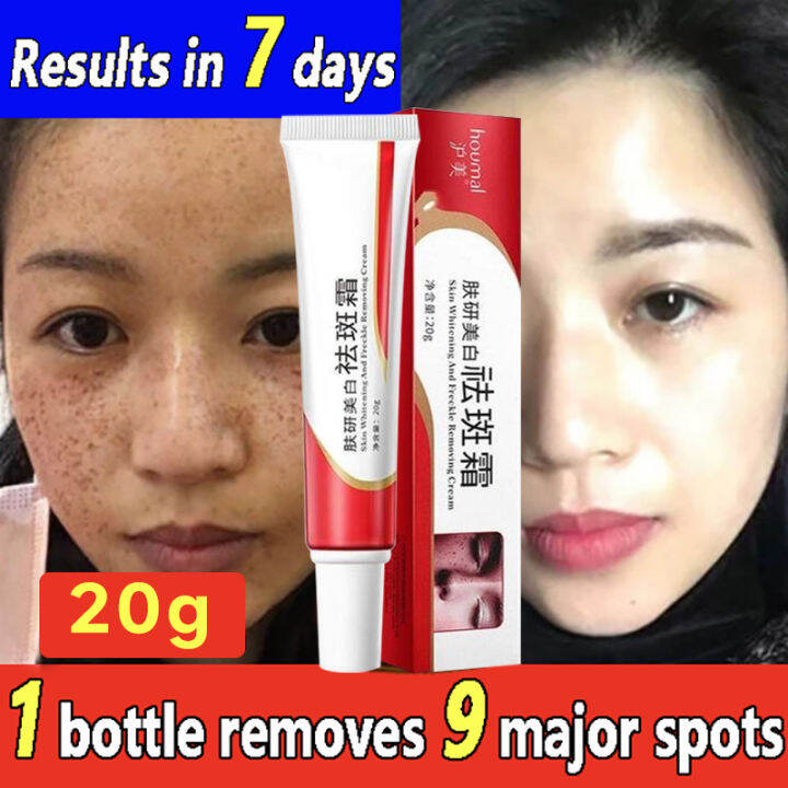 Pekas Remover Very Effective Whitening Freckle Remover Cream ...