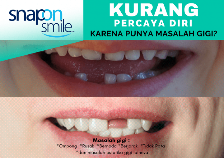 gigi ompong | Lazada Indonesia