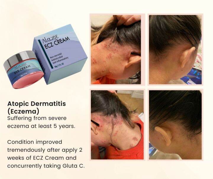 Alazne ECZ Cream - Eczema Cream / Psoriasis Cream / Anti Fungal Cream ...
