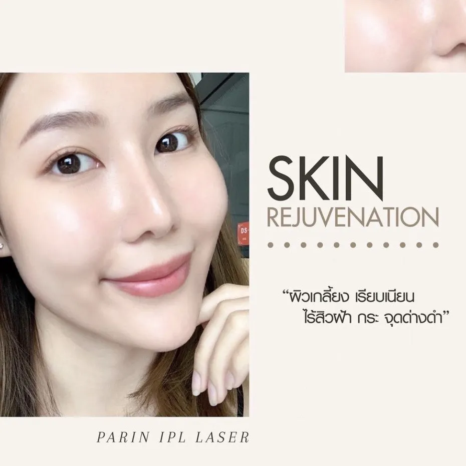 SET PARIN IPL LASER & MINI HIFU : เลเซอร์กำจัดขน & เครื่องนวดหน้ายก ...