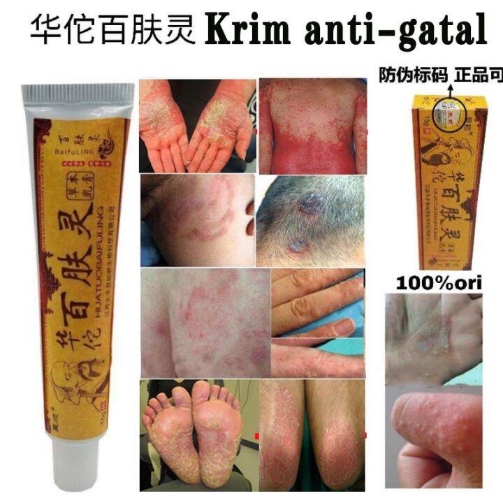 Natural Chinese Herbal Medicine Cream Eczema Psoriasis Antibacterial ...