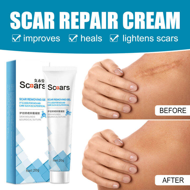 Scar Remover Gel Cream Stretch Marks Removal Ointment Acne Scar Pimples ...