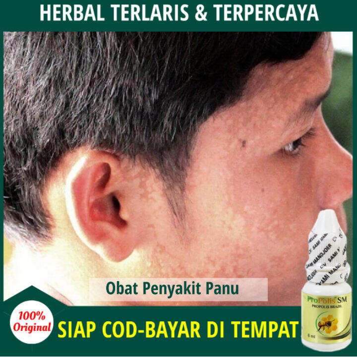 Obat Jamur Kulit Panu, Kurap Kudis, Panu Parah Me-Merah, Hapur di Wajah ...