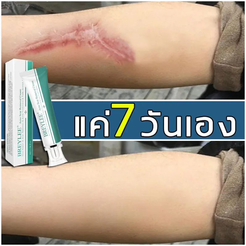 ครีมทารอยแผลเป็น ยาทาแผลคีลอยด์ ลดรอยเเผลเป็น ลบรอยแผลเปน ลบรอยแผลถาวร