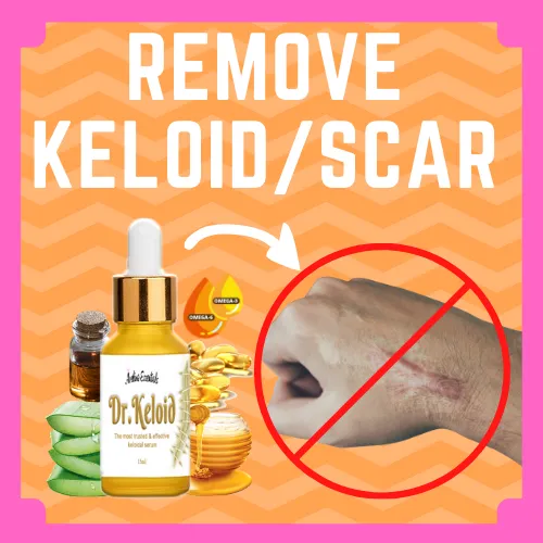 Dr. Keloid Keloid treatment ( Keloid scar remover effective / Keloid ...