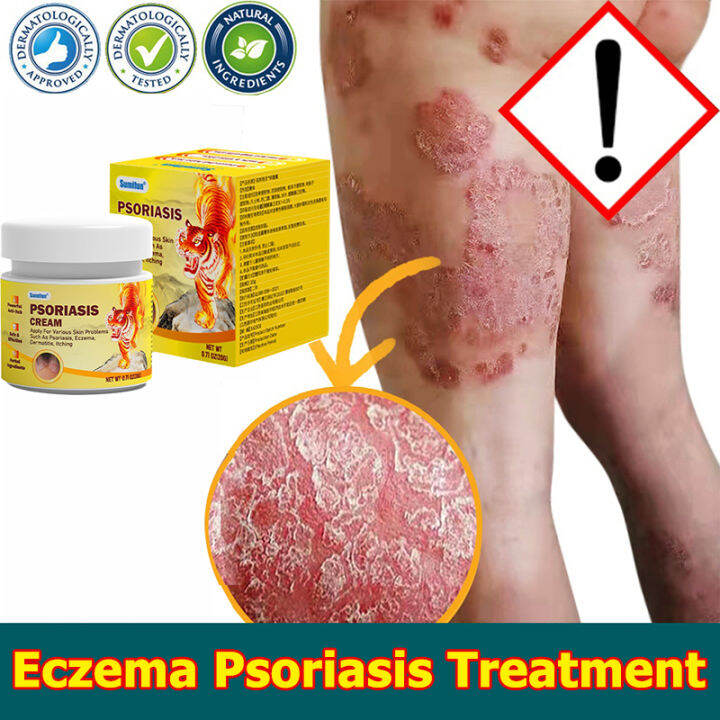 Psoriasis Treatment Cream Eczema Treatment Cream Anti Itch Cream For ...