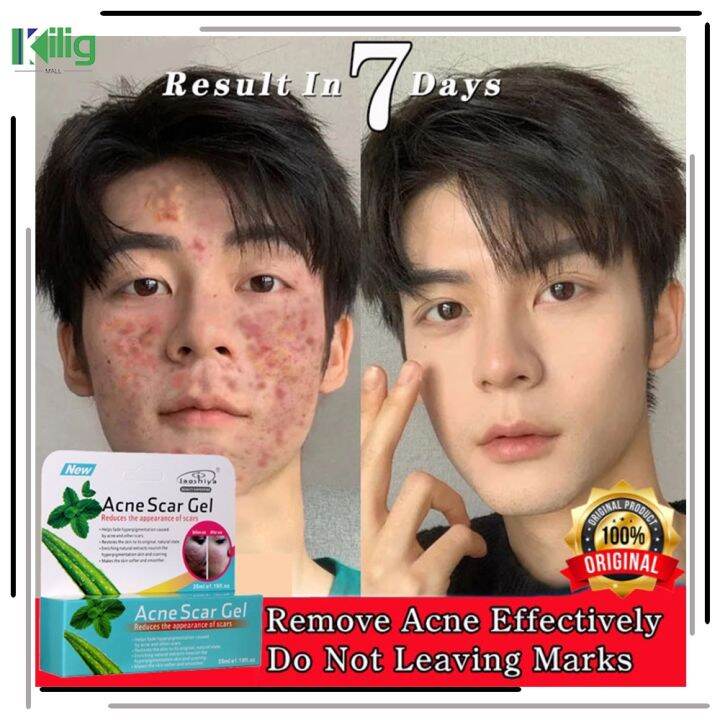acne cream ginseng herbal pimple remover acne marks remover skin care ...