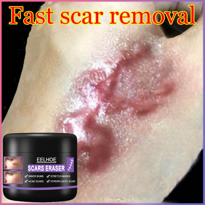 Original Scar Repair Cream for Old Scar scar remover cream Stretch Mark ...
