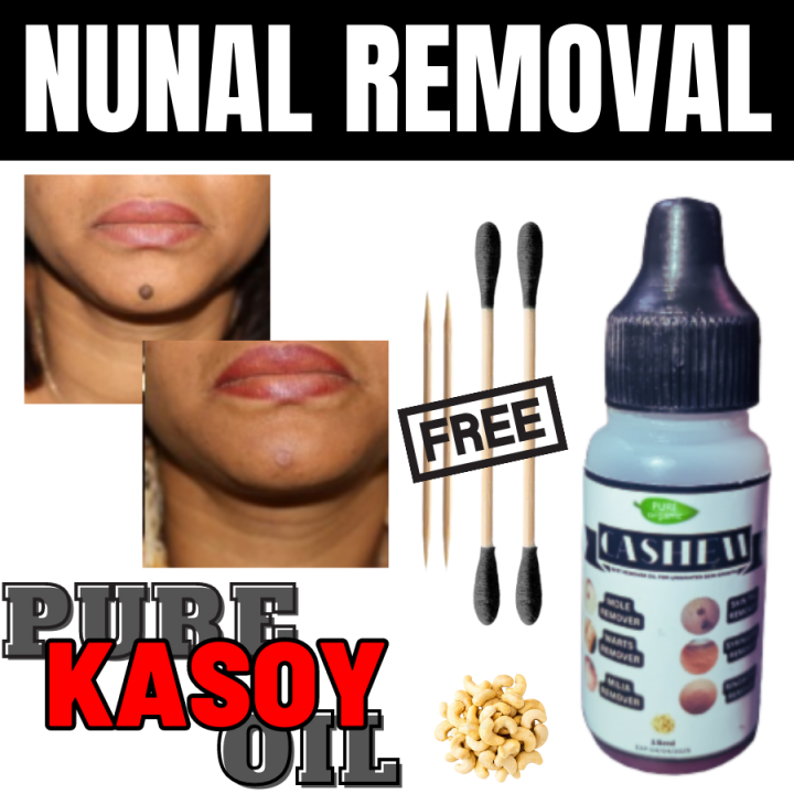 NUNAL REMOVAL CASHEW OIL , nunal remover original , nunal removal cream ...