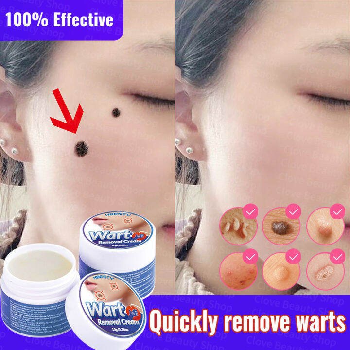 Warts Remover Original cream warts removal cream Warts Remover Cream Mole And Warts Remover ...